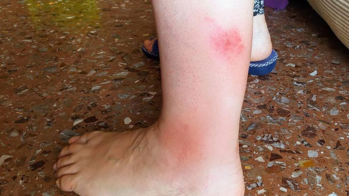 Guía completa sobre picaduras de mosca negra: síntomas y tratamientos ...